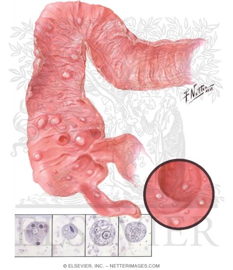 Amebic Colitis