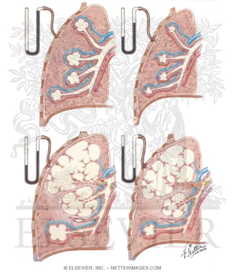 Pulmonary Blood Vessels In Emphysema
