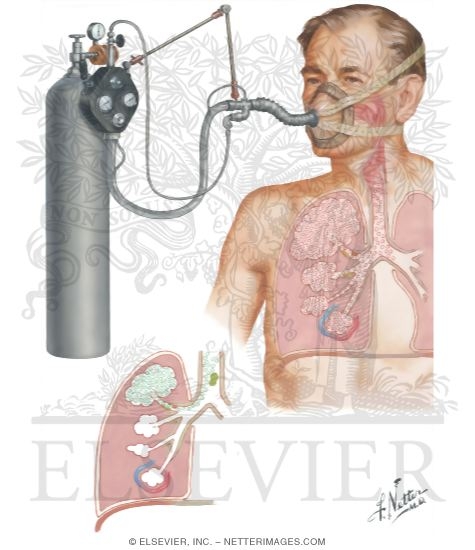 Intermittent Positive Pressure Breathing