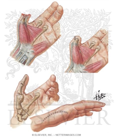 Amputations Of Upper Extremity