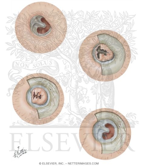 Transmeatal Tympanoplasty