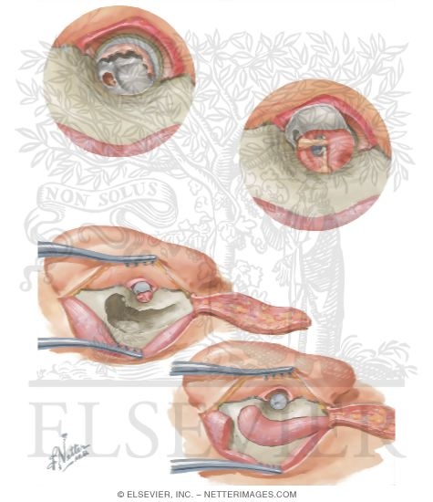 Radical Mastoidectomy
