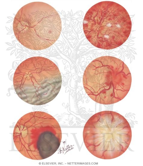 Retinal And Optic Nerve Lesions