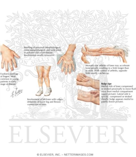 Joint Involvement In Juvenile Arthritis