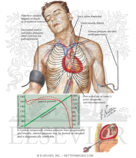 Right Atrium and Ventricle