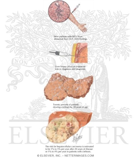 Clinical Picture of Hepatitis C Infection