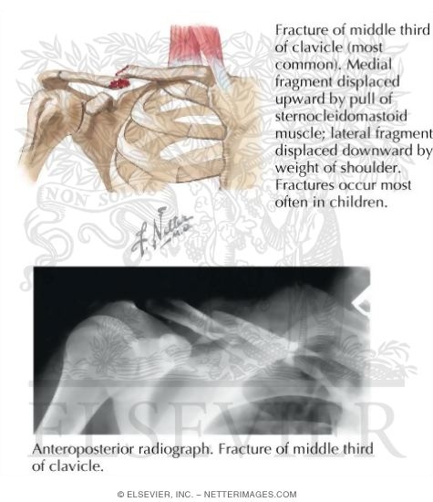 Fracture of the Clavicle