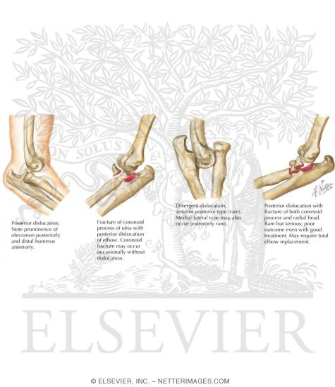 Dislocation of Elbow Joint