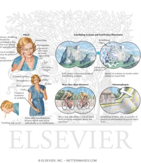 Migraine Fortification 5 Incredible Causes Of Fortification Spectra