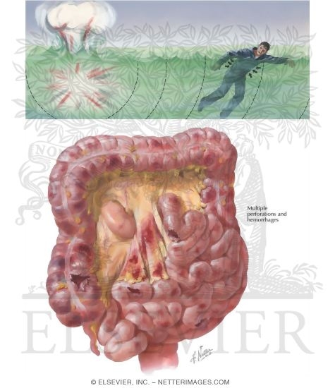 Abdominal Wounds V - Blast Injuries
