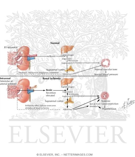 Renovascular Hypertension