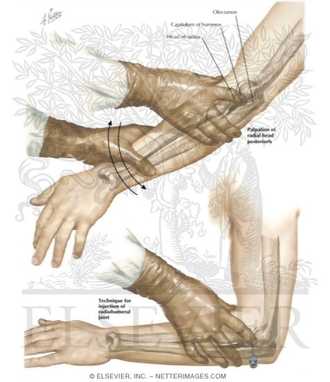 Joint Paracentesis