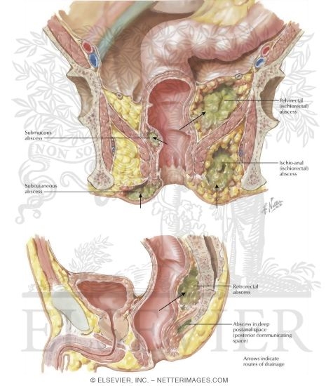 pelvirectal abscess