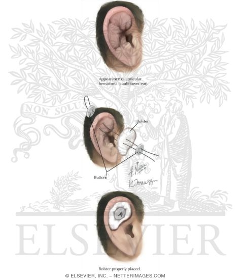 Auricular Hematoma Bolster
