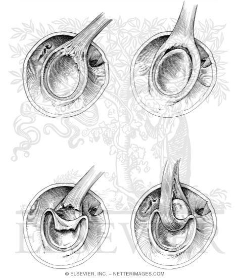 Superior Labrum Anterior and Posterior (SLAP) Injury