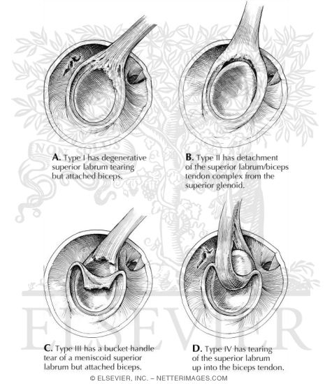 Superior Labrum Anterior and Posterior (SLAP) Injury
