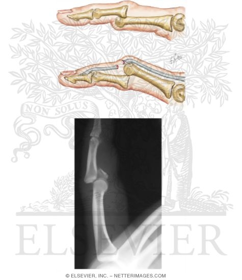 Proximal Interphalangeal (PIP) Joint Dislocation