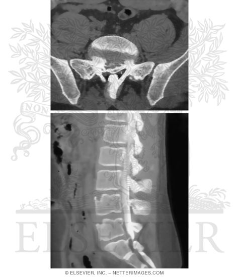 Slipped Apophyseal Ring