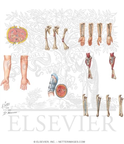 Upper Extremity Fractures and Dislocations