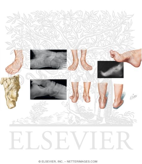Anatomic Variants of the Foot