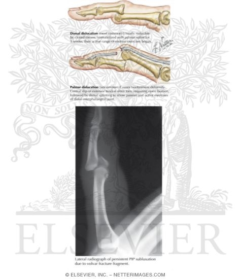 Proximal Interphalangeal (PIP) Joint Dislocation