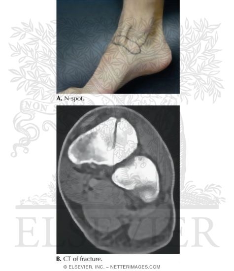 Navicular Stress Fracture