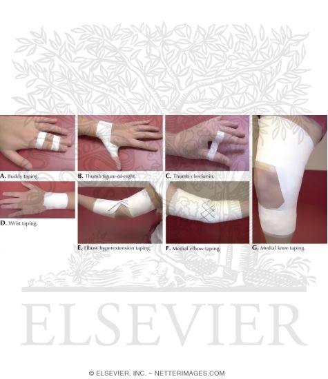 Various Taping Procedures