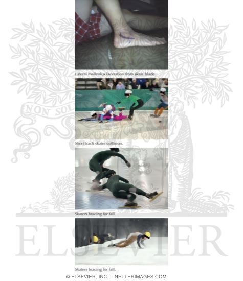 Speed Skating Injuries