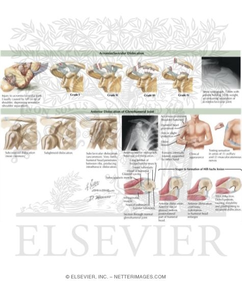 Watermarked preview of labeled image: Shoulder Injuries In Lacrosse