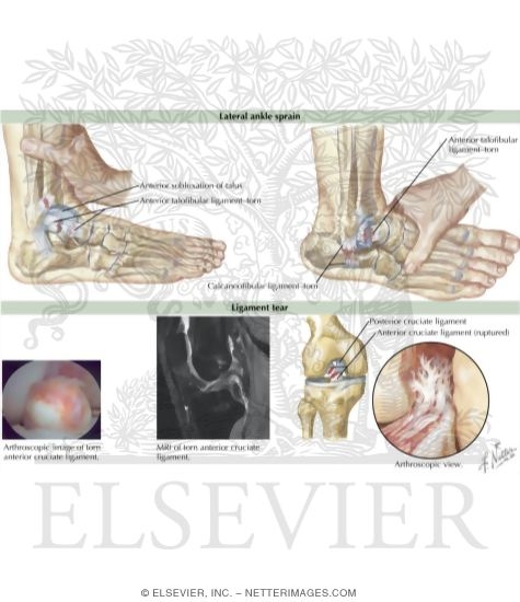 Lower Extremity Injuries In Lacrosse