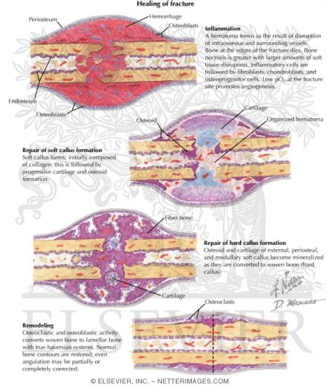 Healing of Fracture