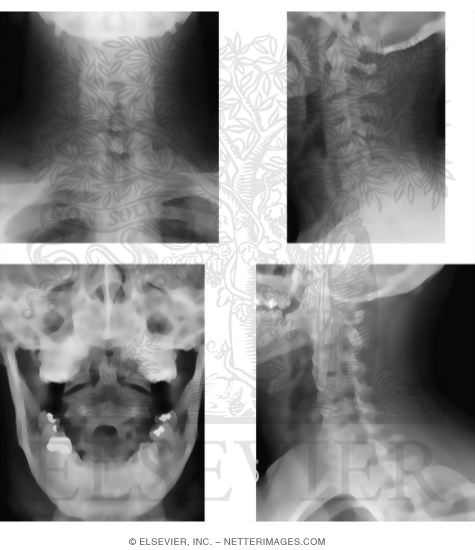 Radiology of the Spine