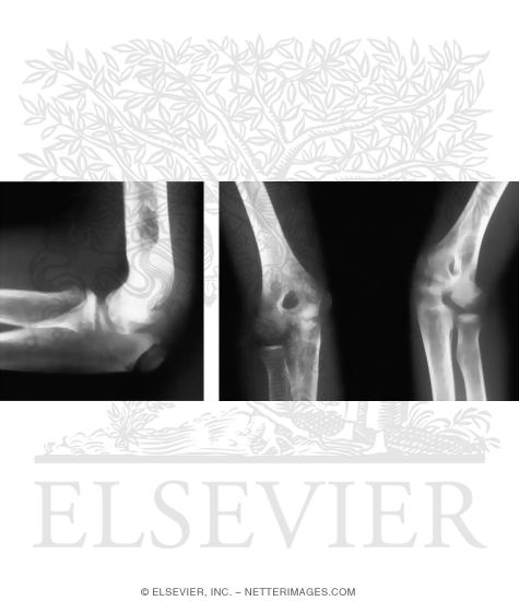 Osteochondral Lesion of the Capitellum