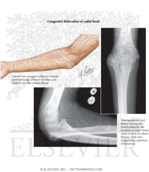 Congenital Dislocation of Radial Head