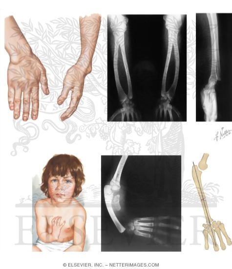 Pediatric Disorders of the Forearm
