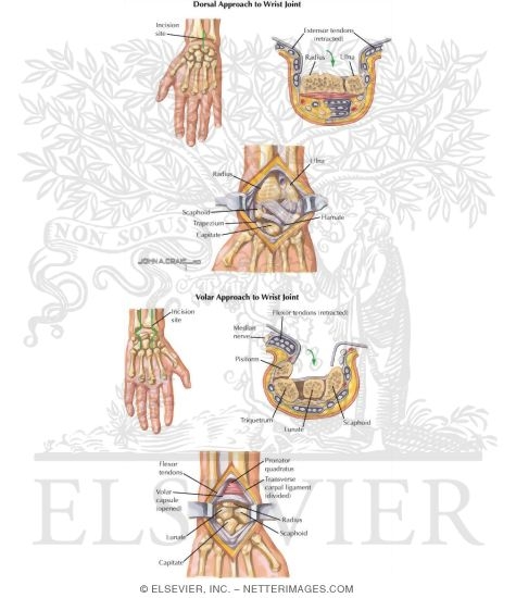 Surgical Approaches to the Wrist