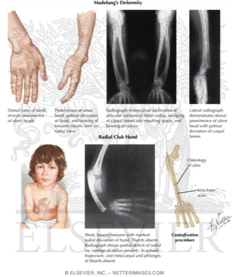 Pediatric Disorders of the Forearm