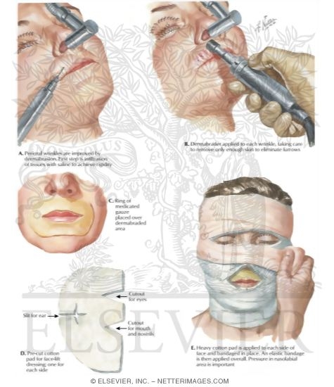 Rhytidectomy (Face Lift): Abrasion of Perieoral Wrinkles