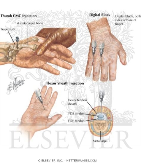 Minor Procedures of the Hand