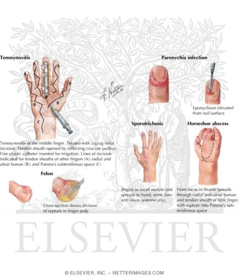 Horseshoe Abscess Hand