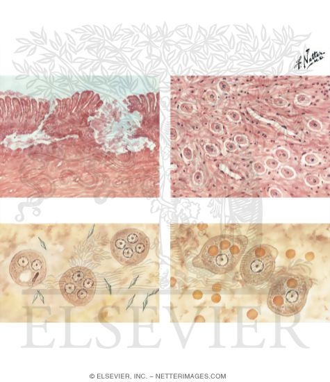 Amebiasis: Pathology and Diagnosis