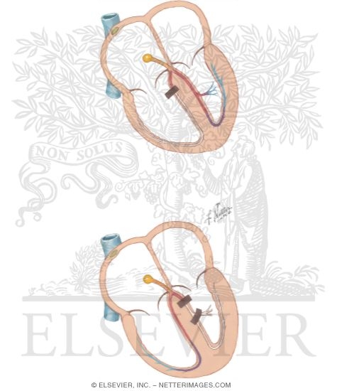 Right Bundle Branch Block