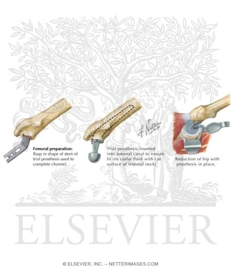 Disorders of the Thigh and Hip