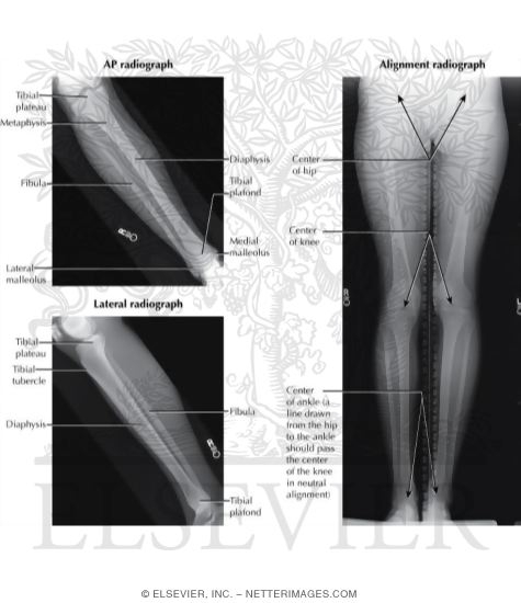Radiology of the Leg and Knee