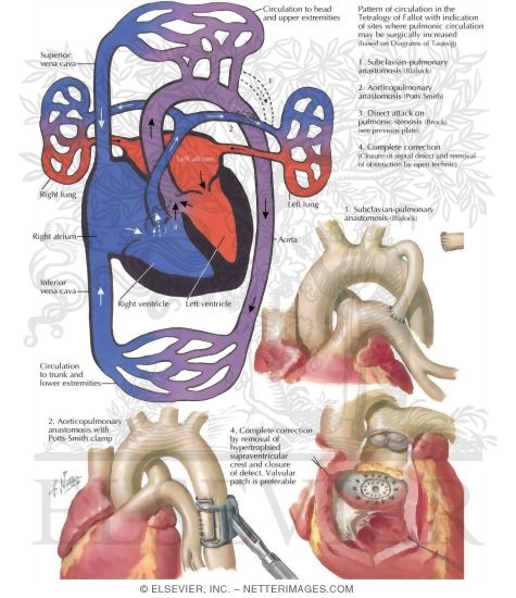 Tetralogy Of Fallot