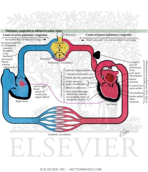 Pulmonary Congestion or Edema of Cardiac Origin