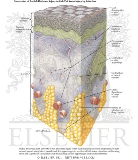 Conversion of Partial Thickness Injury to Full Thickness Injury By ...
