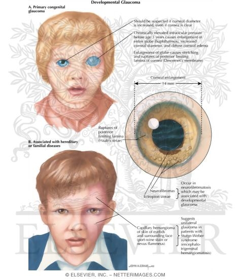 Developmental Glaucoma