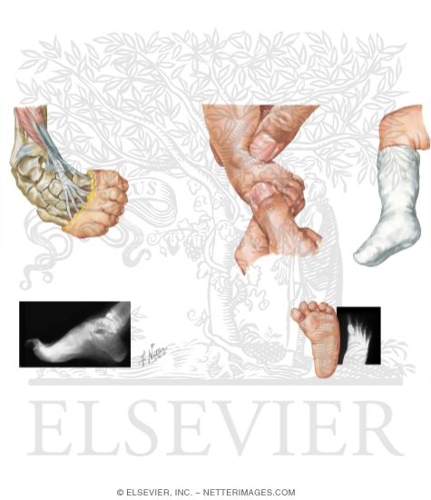 Pediatric Disorders of the Foot and Ankle