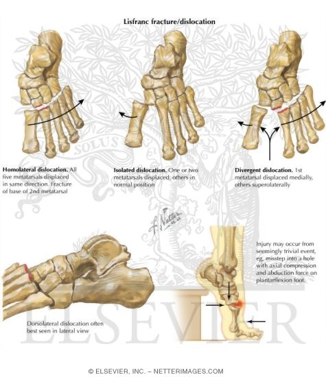 Injury to Tarsometatarsal (Lisfranc) Joint Complex